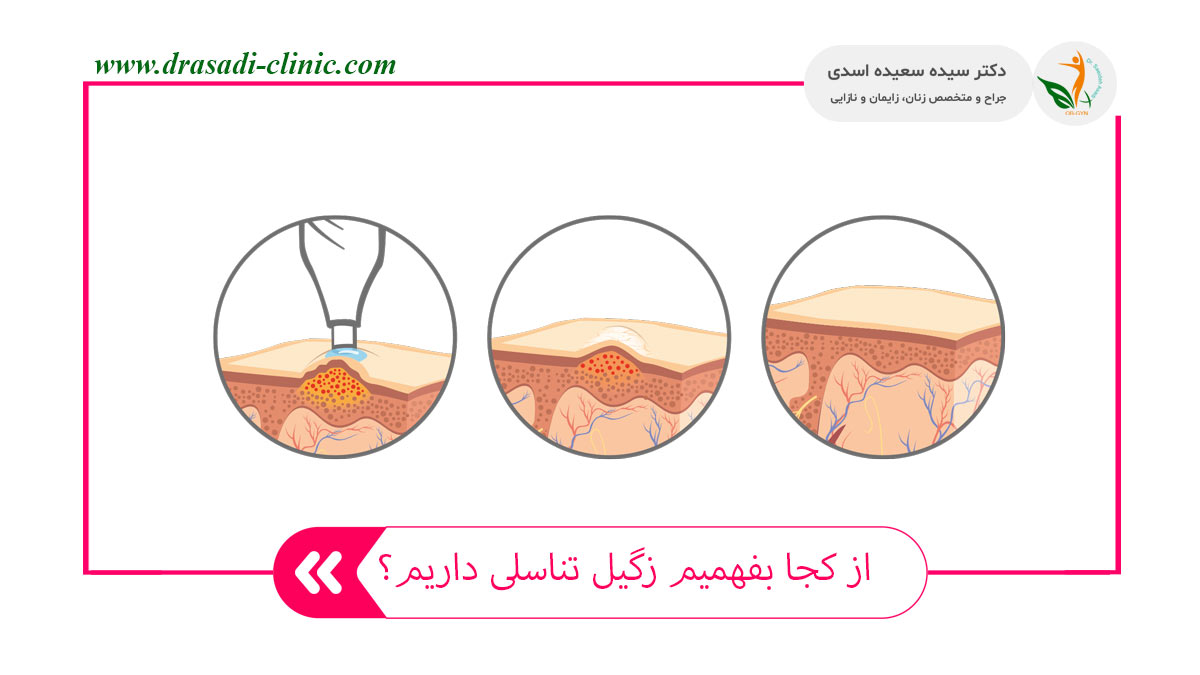 زگیل تناسلی مردان چیست؟ علت، علائم و درمان زگیل دکتر سعیده اسدی